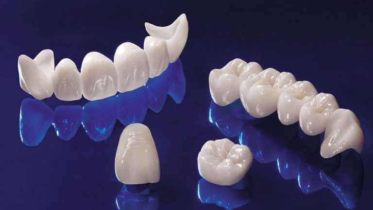 Crowns Bridge – White Willow Dental